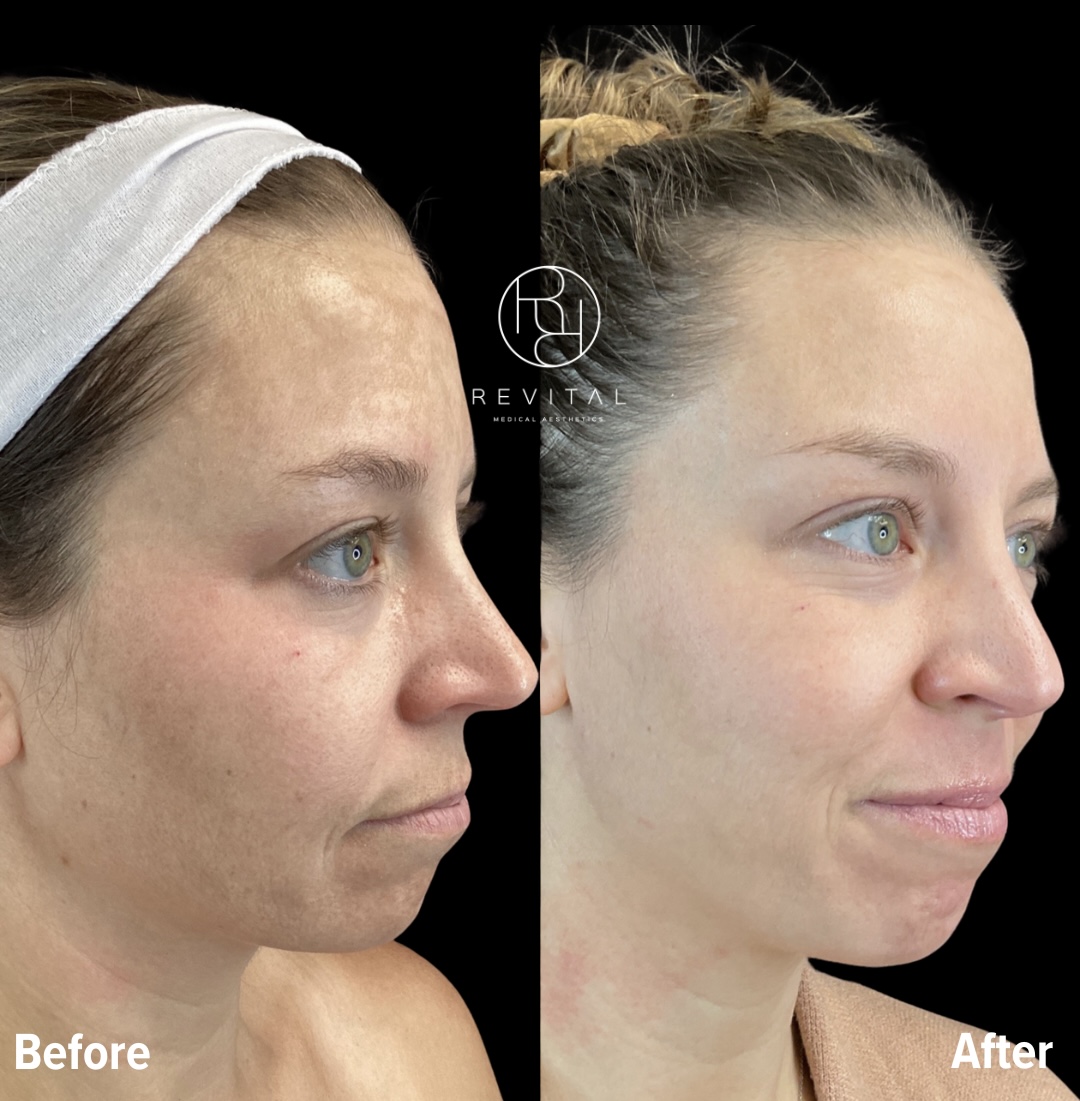 PRF Microneedling - Revital Medical Aesthetics