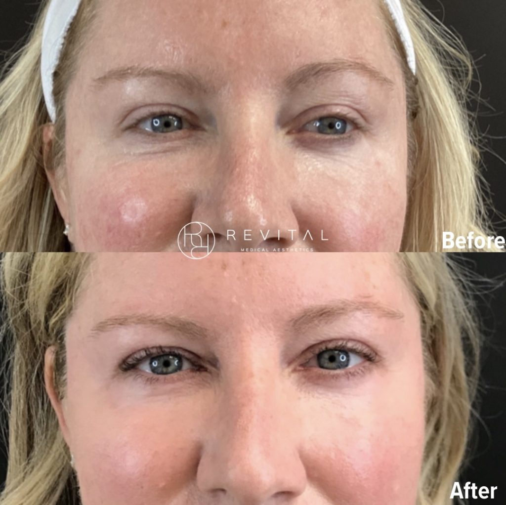 Before & After - Revital Medical Aesthetics